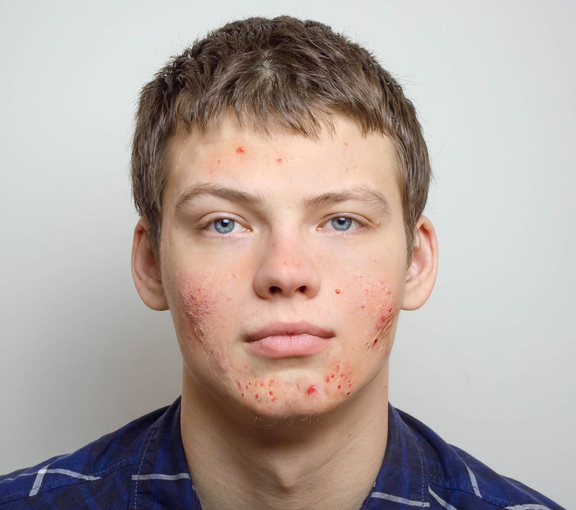 Aklief, Amzeeq, Winlevi: Newest Drugs for Acne Vulgaris Treatment ...