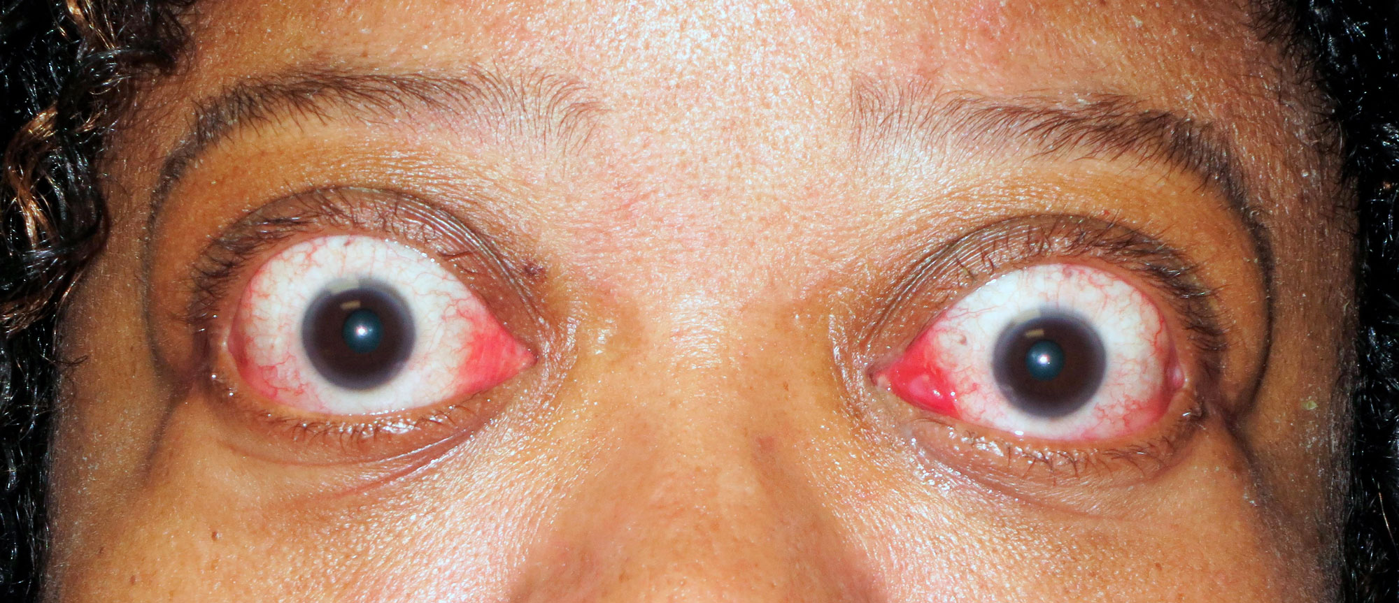 Tepezza: First Drug for Thyroid Eye Disease | BioPharma.News