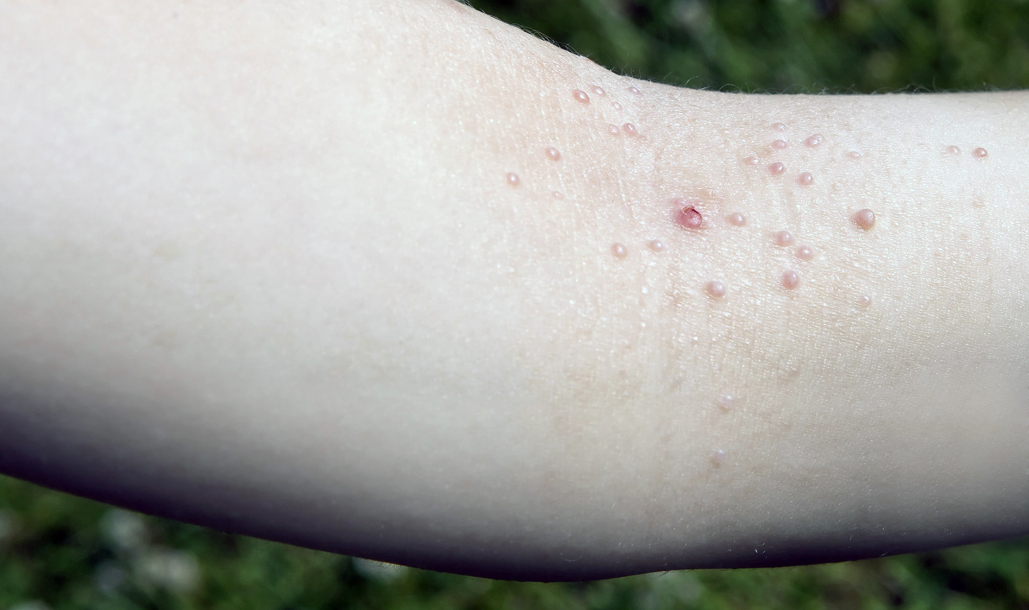 Ycanth: First Treatment for Molluscum Contagiosum and Warts | BioPharma ...